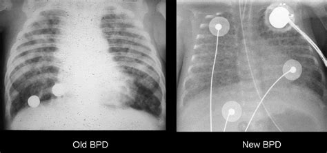 Ventilatory Management And Bronchopulmonary Dysplasia In Preterm