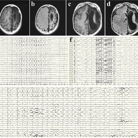 A Case Of Atypical Absence Seizures In Lgs No 1 In Table 1 A D Download Scientific Diagram