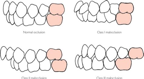 Normal Occlusion Vs Class 1 At Peggy Rios Blog