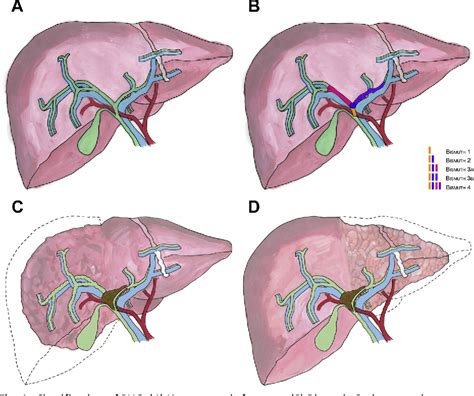 Figure 1 From Resection Of Perihilar Cholangiocarcinoma Semantic Scholar