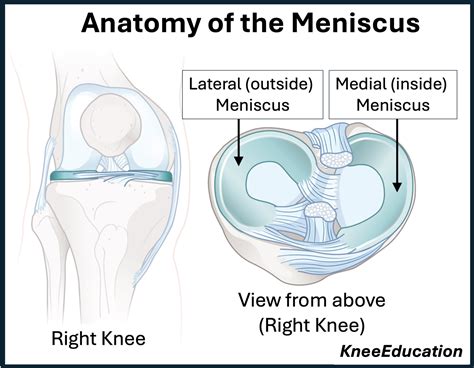 Meniscal Tear Torn Meniscus Knee Education