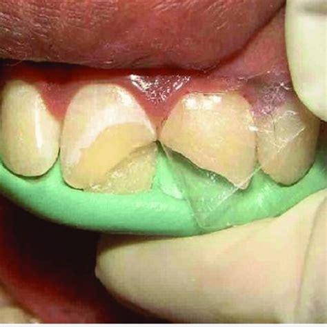 Pdf Anterior Matrix Systems For Composite Restorations A Review