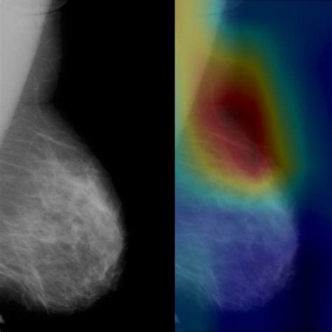 Regional Punctate Calcifications Classified As Bi Rads 3 The Final Download Scientific Diagram