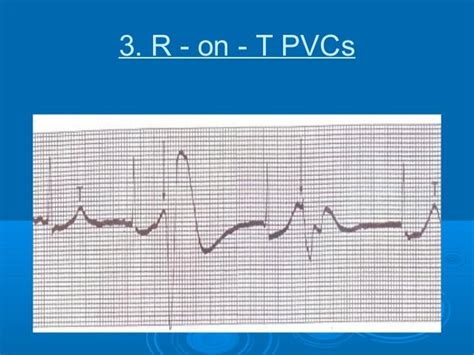 Recurrent Ventricular Arrhythmia After Cardiac Surgery