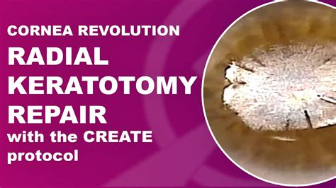 Prior Radial Keratotomy Treatment With The Create Protocol Dr Manoj