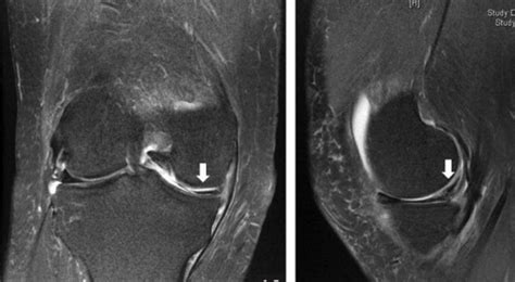 Mri Knee Meniscus