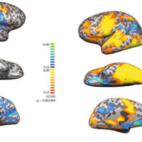 A Ffx Glm Group Activation Map For The Inner Speech Runs Qfdr