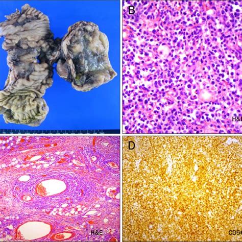 A Gross Appearance Of The Resected Terminal Ileum Showing Hemorrhage Download Scientific