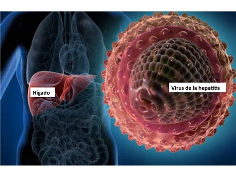 ¿qué Es La Hepatitis Dr Onofre AlarcÓnmÉdico Especialista En