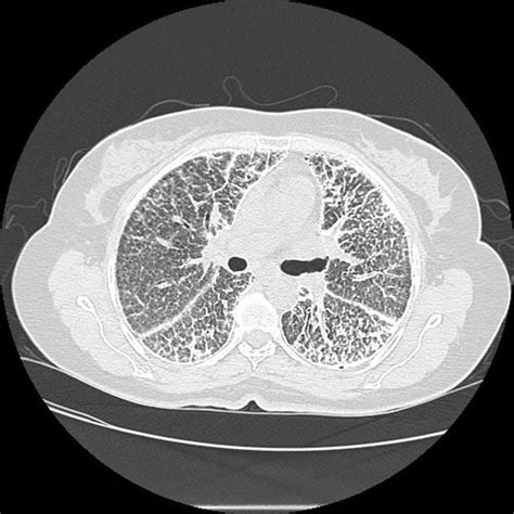 Tree In Bud On Ct Chest Gwenda Bachman