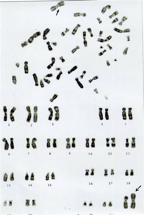 G Banded Karyotype Of Patients No 26 Group 2 Showing 46xi Xq