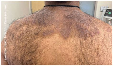 Refractory Tinea Corporis Or Cruris Caused By Trichophyton Indotineae