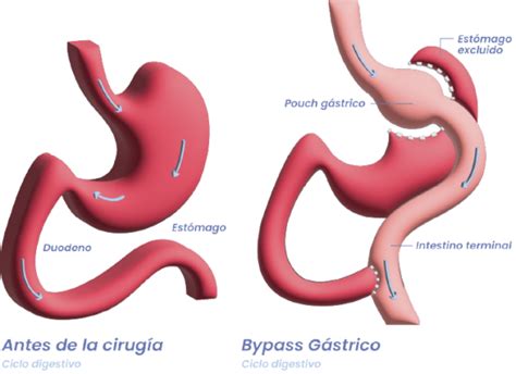 Bypass Gástrico La Cirugía Bariátrica Ideal Para Personas Con Obesidad