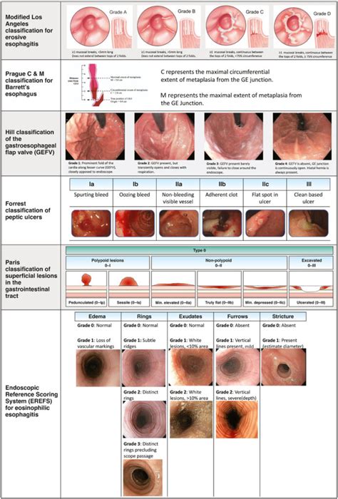 Nine Tips To Improve Your Upper Endoscopy Exams American