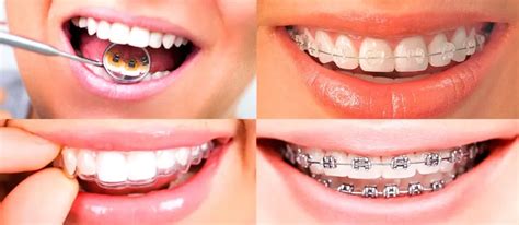 Tipos De Brackets Qué Son Y Cómo Funcionan 2025