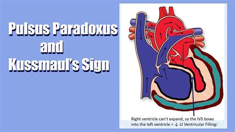 Pulsus Paradoxus And Kussmauls Sign A Sign Of Heart Trouble A Live