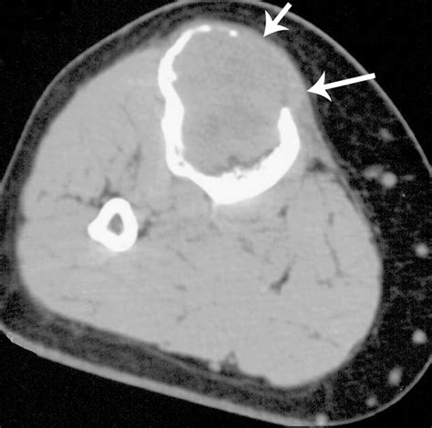 Imaging Of Musculoskeletal Liposarcoma With Radiologic Pathologic