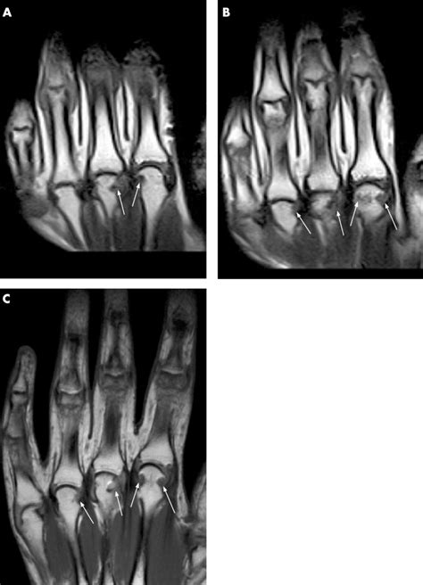 Comparison Of Erosions At Metacarpophalangeal Mcp Joints 2 4 Same