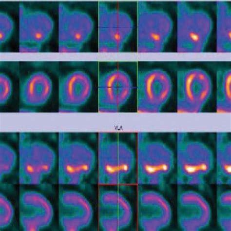 A Spect Myocardial Perfusion Vla Images Showing Diffuse Hypoperfusion