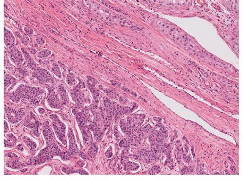 Pre Pubertal Type Testicular Neuroectodermal Tumour Download Scientific Diagram