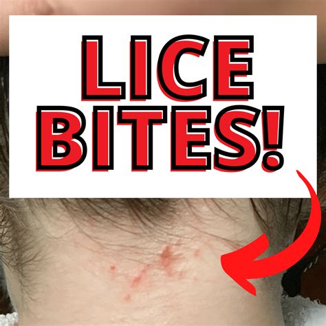 Pubic Lice Bites How To Treat Pubic Lice Symptoms Treatments And