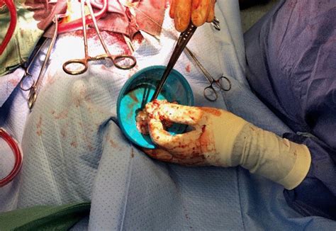 Intra Operative Image Of The Atrial Sarcoma Immediately After Resection Download Scientific