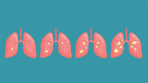 What Is The Life Expectancy Of A Person With Lung Cancer Sharp