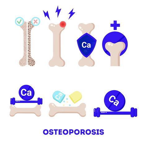 Premium Vector Osteoporosis Vector Illustrations Set Medical