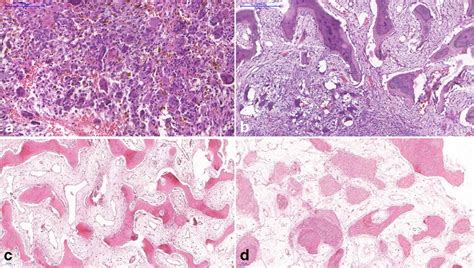 A Presence Of Numerous Multinucleated Giant Cells Dispersed In Dense