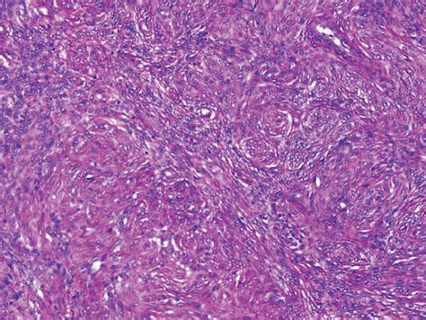 Histopathological Findings Of The Nodule In Nodule Appearance A In