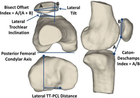 Trochlear Notch Knee