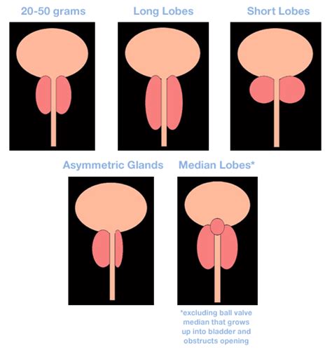 Median Lobe Prostate