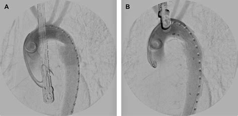 Traumatic Aortic Rupture 30 Years Of Experience Semantic Scholar