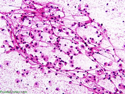 Tumefactive Demyelination Intraoperative Crush Preparation X 200