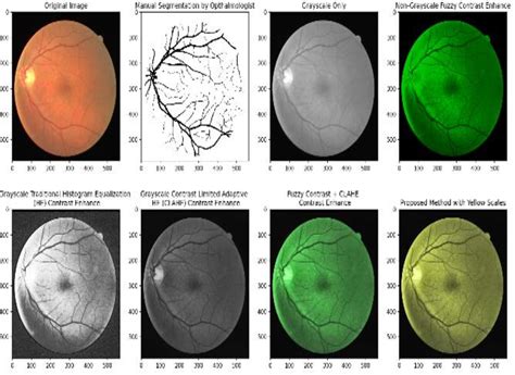 Figure 1 From A Novel Retinal Image Contrast Enhancement Fuzzy Based