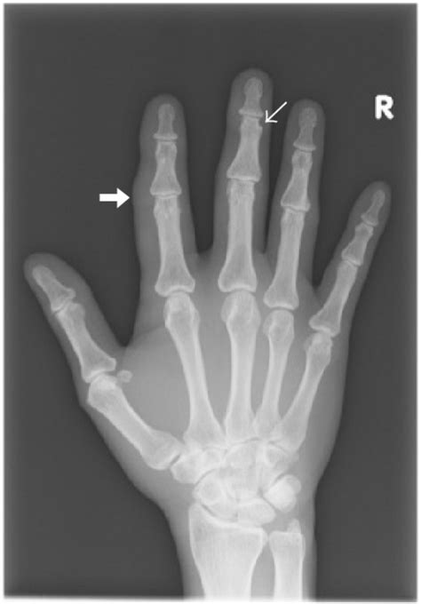 Frontal Radiograph Of The Right Hand Shows Focal Periar Open I
