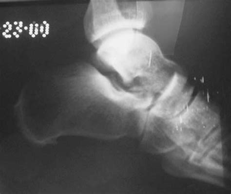 Subtalar Dislocations Trauma Orthobullets