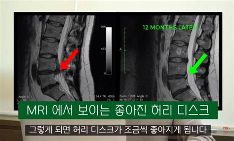 잠자는 자세만 바꿨는데 기적이 일어났어요 너무 고통스러워 수술 날짜 보고 있었는데 허리통증이 싹 사라졌다고 웰빙미디어