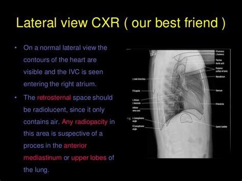 Basic Approach For Cxr Interpretation