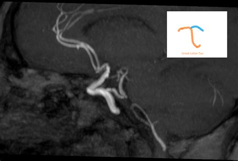 Persistent Primitive Trigeminal Artery Pacs