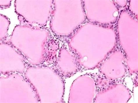 Thyroid Neoplasms Of Pathology Robbins Pptx