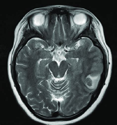 Focal Bleeding Infarction And Edema On Axial T2 Magnetic Resonance