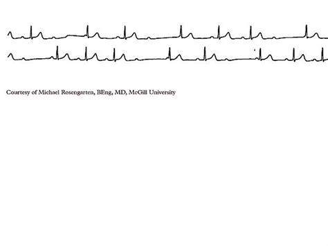 ECG Lecture Sinus Arrest Sinoatrial Exit Block AV Block And Escape Rhythms PPT