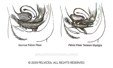 Pelvic Floor Trigger Points Diagram Female