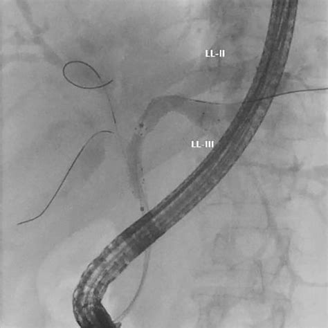 Fluoroscopic Image Showing Bismuth Corlette Type Iv Perihilar Download Scientific Diagram