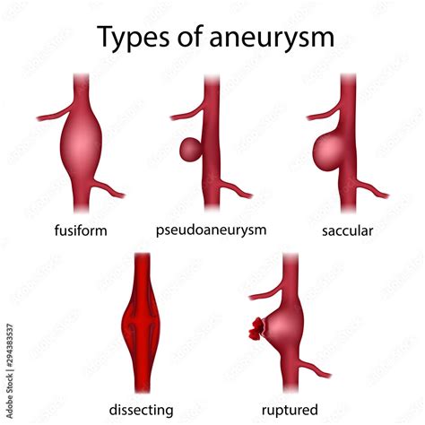Types Of Saccular Aneurysm