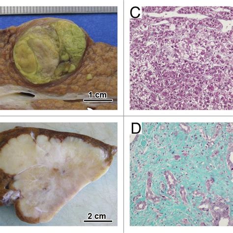 Hepatocellular Carcinoma And Cholangiocarcinoma Gross Appearances Of A Download Scientific