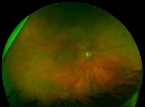 New Study Reveals No Correlation Between Body Fat And Diabetic