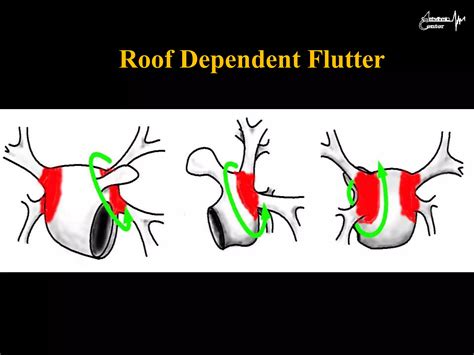 Ablation Of Atypical Flutter Ppt