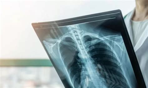 فیبروز کیستیک Cf چیست؟ علل، علائم و انواع درمان دکتر اردا کیانی